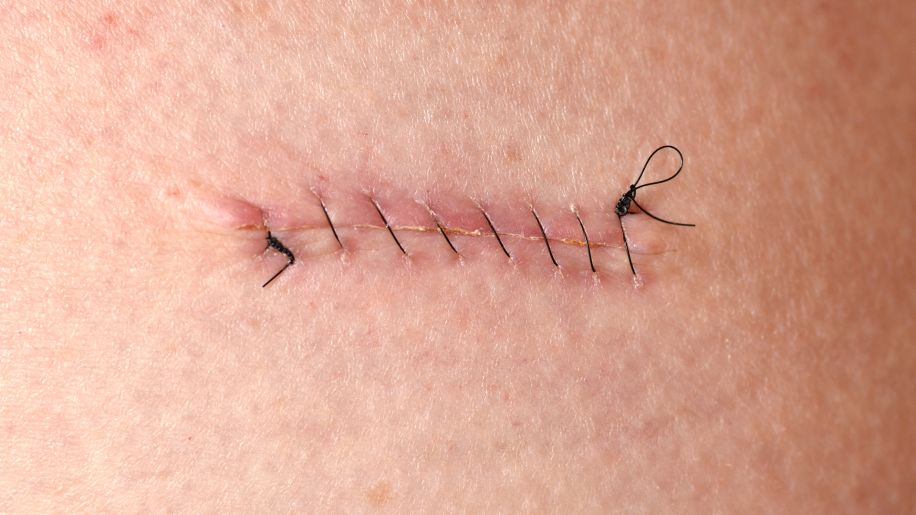 What Does Skin Cancer Really Look Like? | cancer - Sharecare