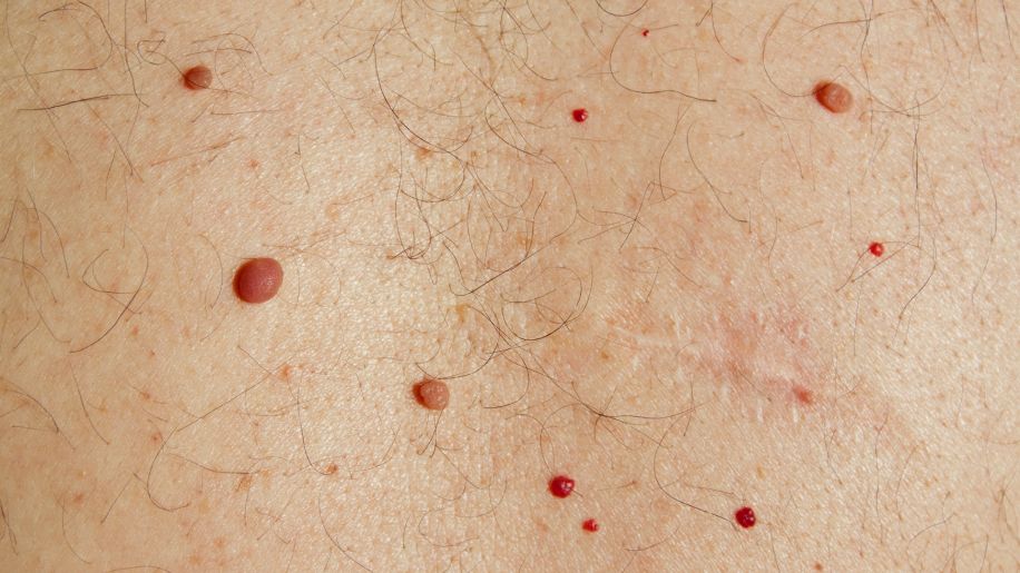 What Does Skin Cancer Really Look Like? | cancer - Sharecare